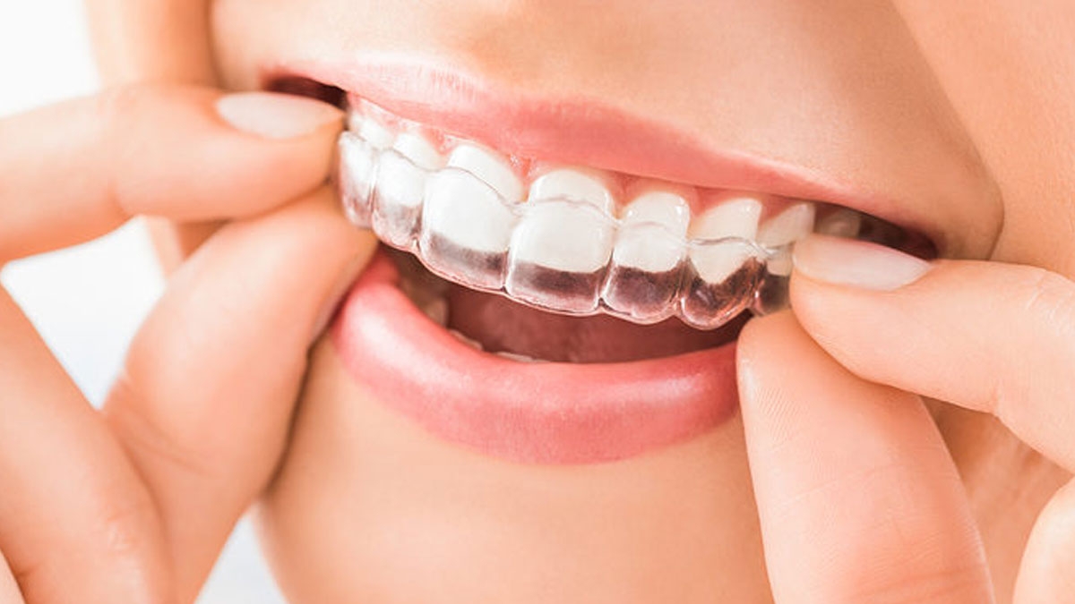 The Benefits of Realigning Your Teeth - Snooth