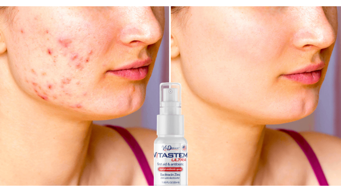 The Most Severe Types of Acne & How Vitastem Ultra Can Help Spray Away ...